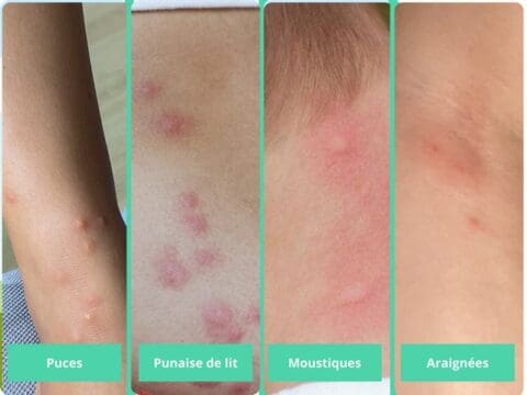 Piqûre d’acariens : identification (avec photos) et traitement