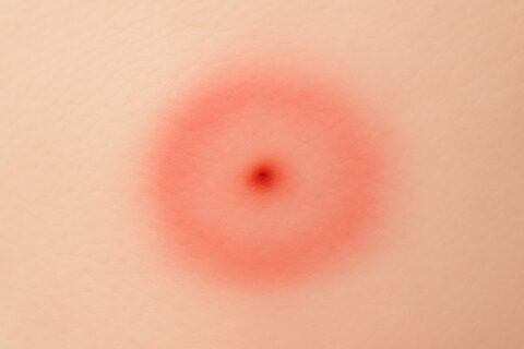 Piqûre de tique : Caractéristiques, risques et traitements