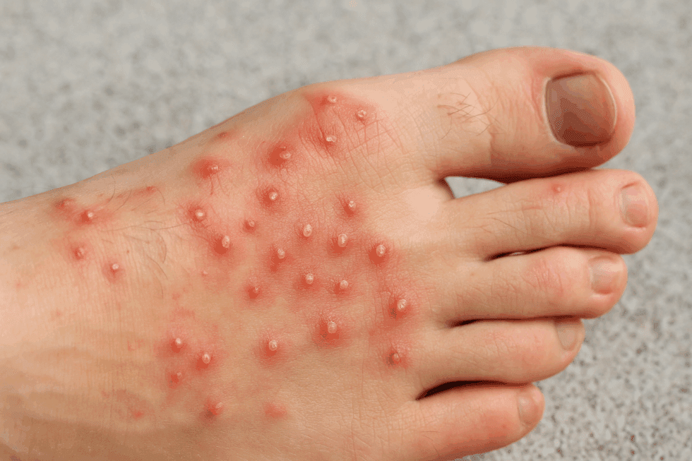 Fourmis de feu : identification, dangers et solutions